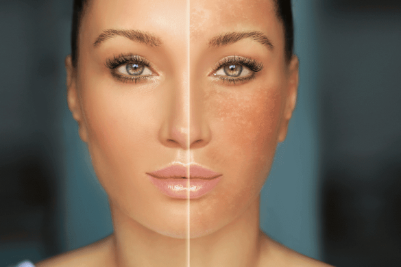 Understanding Hyperpigmentation: Causes and Treatment